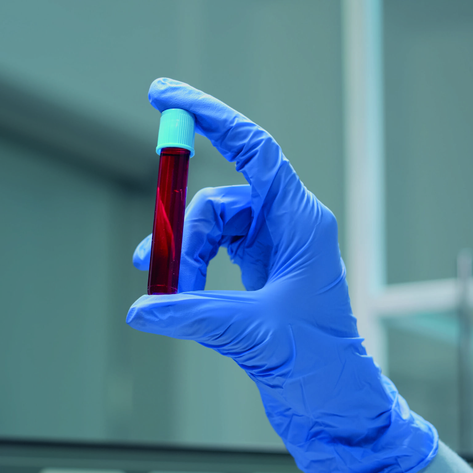 Diagnóstico Laboratorial da Anemia Perniciosa (AP) - Laboratório ...